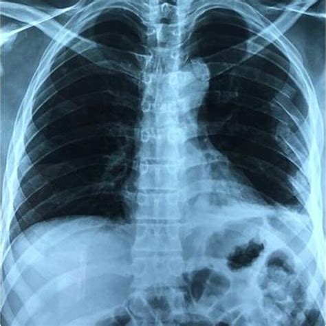 Chest Radiograph Showing Suspected Elevation Of Left Hemidiaphragm And Download Scientific