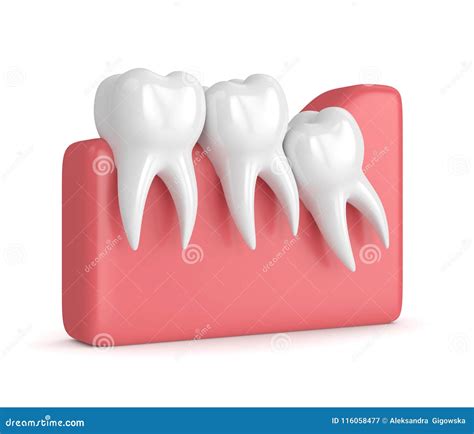 3d Teeth With Wisdom Mesial Impaction Problem Cartoon Vector