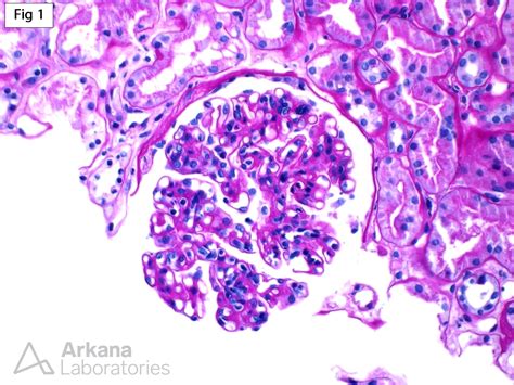 Proliferative Glomerulonephritis With Monoclonal Igg Deposits
