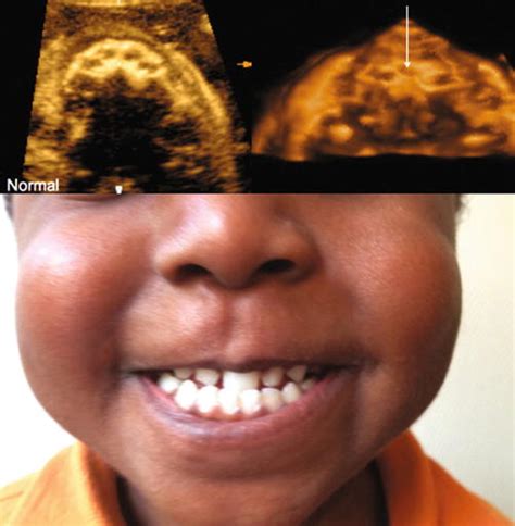 Dysmorphism Radiology Key