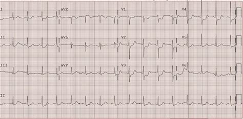 Dr Smiths Ecg Blog Pure Isolated Posterior Stemi Not So Rare