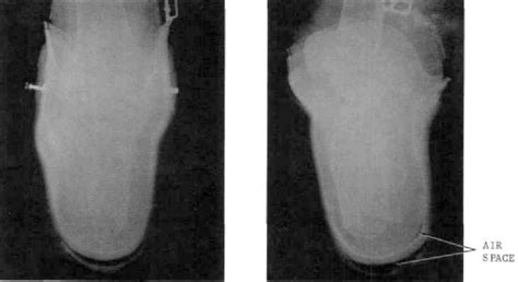 Figure 1 From Radiographic Evaluation Of Stump Socket Fit 1 Semantic