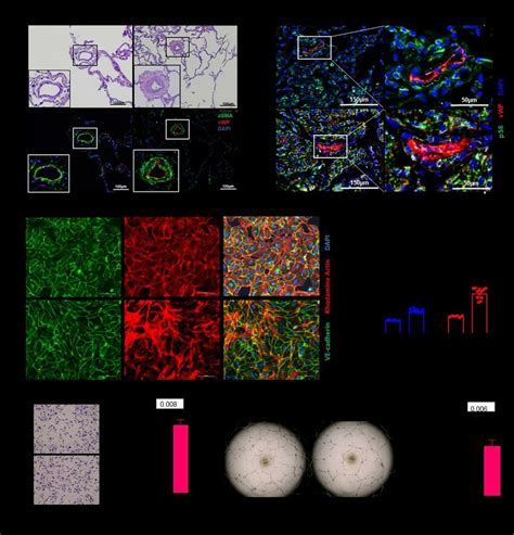 Characterization Of Pulmonary Ecs From Patients With Lam A