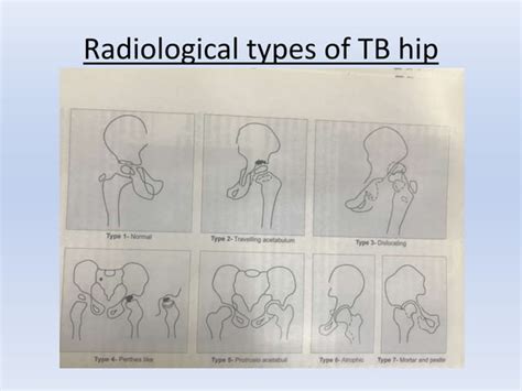 Tuberculosis Of Bone And Joints Pptx