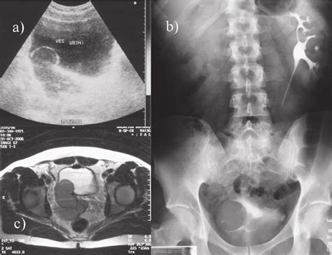 A Sonography Of The Urinary Bladder Showing An Intravesical