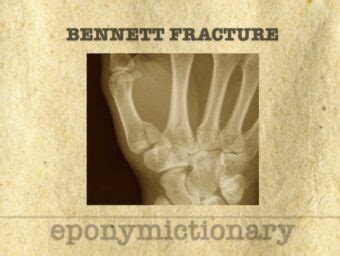 Bennett Fracture Archives • Litfl