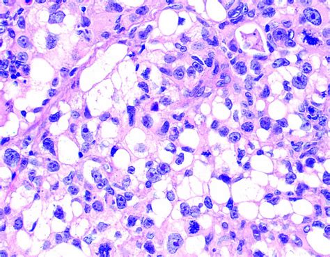 Pathology Outlines Pleomorphic Liposarcoma