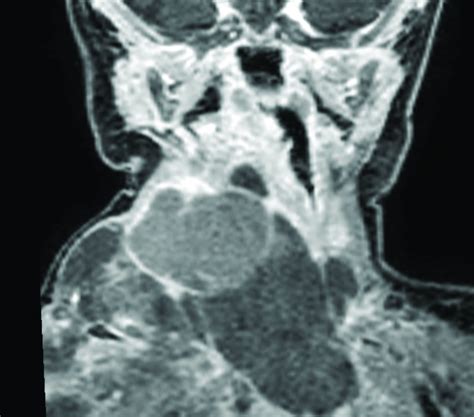 Macrocystic Lymphatic Malformation Applied Radiology