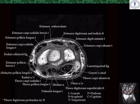 Anatomy And Imaging Of Wrist Joint Mri And Xray Pptx