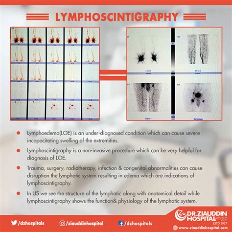 Lymphoscintigraphy At Dr Ziauddin Hospital Clifton Campus Dr