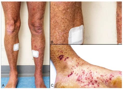A Review Of Atypical Cutaneous Histological Manifestations Of Herpes