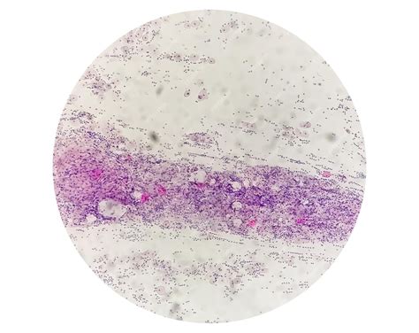 Premium Photo Paps Smear Pap Smear Showing Inflammatory Smear With