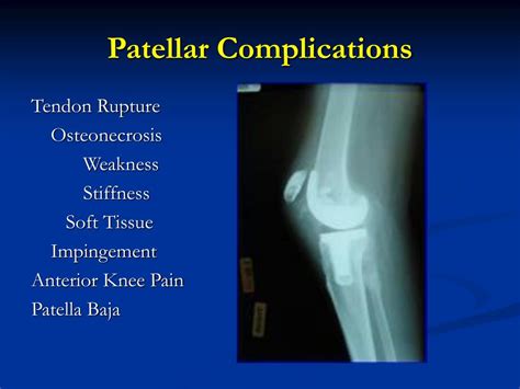 Ppt Optimizing The Patellofemoral Joint In Tkr Powerpoint