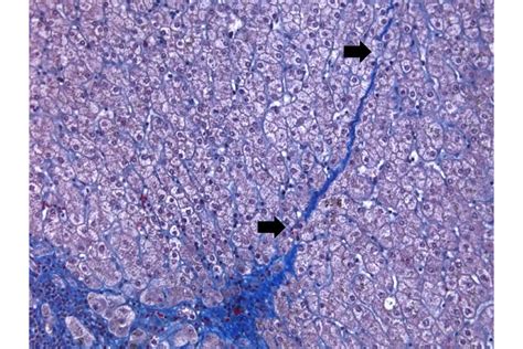 Nyps 2017 Beijing Classification Ppt