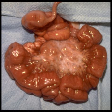 Infant With Bilious Vomiting Pediatric Radiology Case Pediatric Imaging Pedsimaging