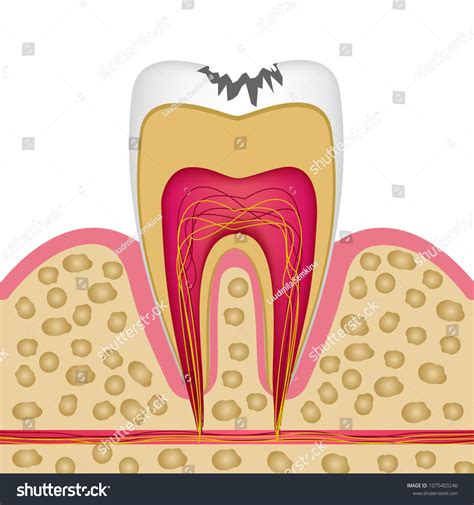Tooth Structure Cross Section Caries Use Stock Vector Royalty Free