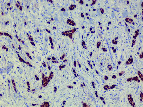 Islands Of P63 Stained Atypical Squamoid Cells In The Dermis 3 200
