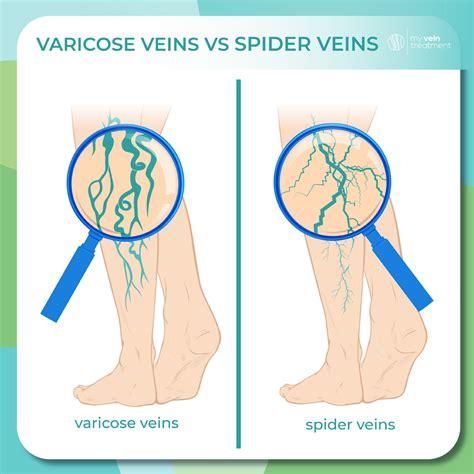 Varicose Veins Vs Spider Veins Whats The Difference