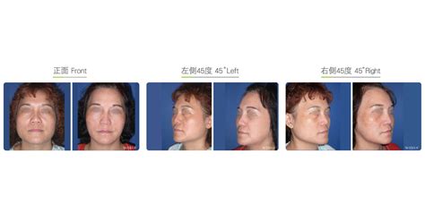 Mandible Angle Splitting Osteotomy Facial Bone Wishclinic