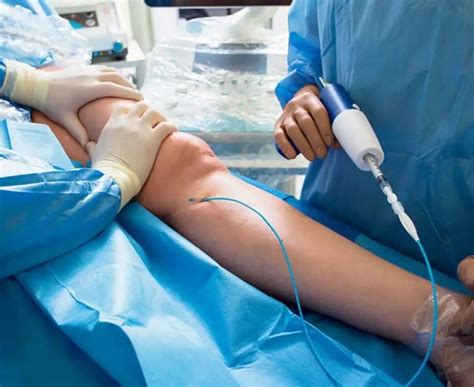 Venaseal Discover Varicose Vein Glue Treatment Perth