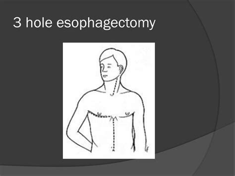 Ppt Post Esophagectomy Atrial Fibrillation Prophylaxis Powerpoint