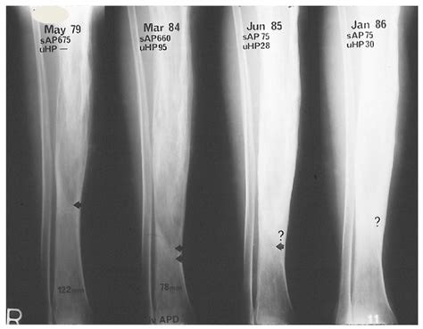 Pagets Disease Tibia Radiology At Marilyn Pierre Blog