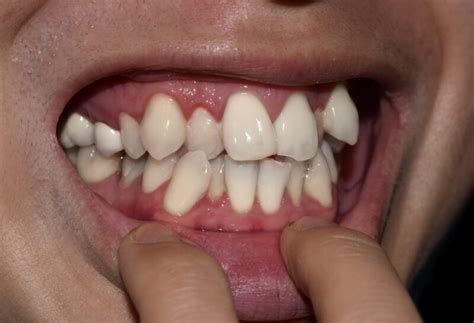 Genetic Factors Impacting Teeth Alignment Ahava Orthodontics