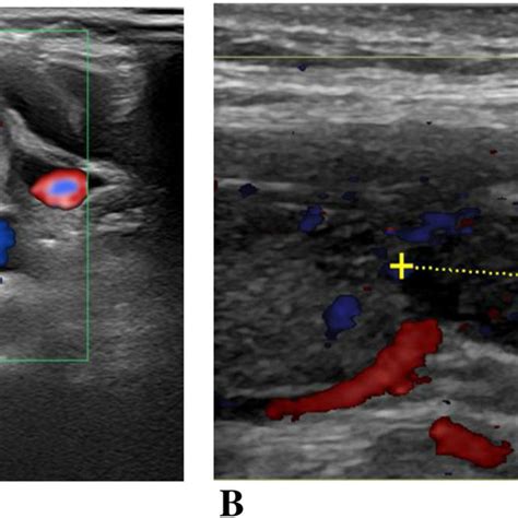 Us Of The Left Thyroid Nodule Download Scientific Diagram