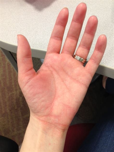 Strep Throat Rash On Hands