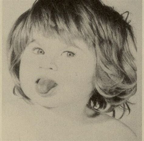 An “unsilencer” Drug May Treat Angelman Syndrome Someday Dna Science