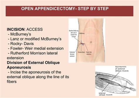Acute Appendicitis Appendicectomy Open And Laparoscopicpdf Surgery
