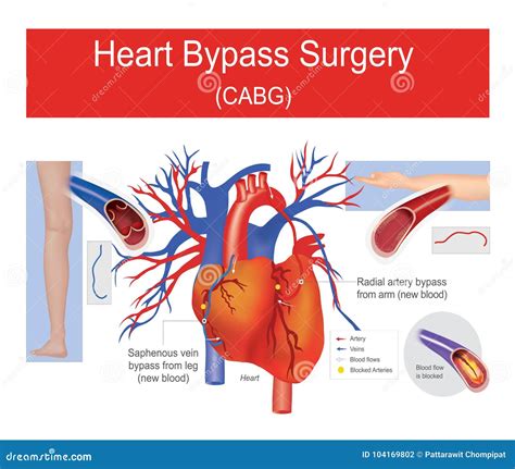 Bypass Heart Stock Illustrations 591 Bypass Heart Stock Illustrations Vectors And Clipart