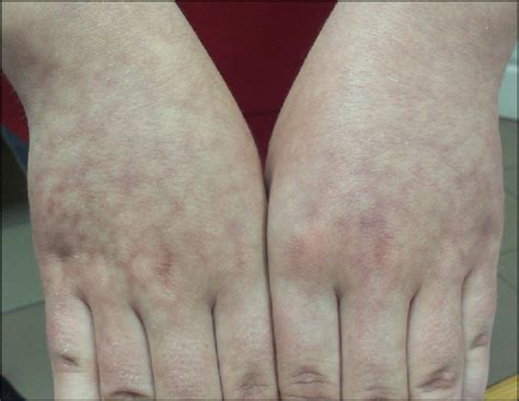 Erythema Ab Igne On Hands Backs Of He Hands And Part Of The Wrists
