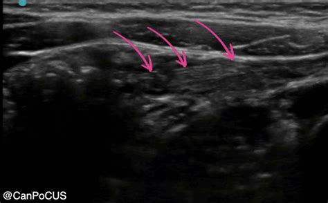 Pediatric Appendicitis Pocus Deep Dive Dont Dive Deep Department