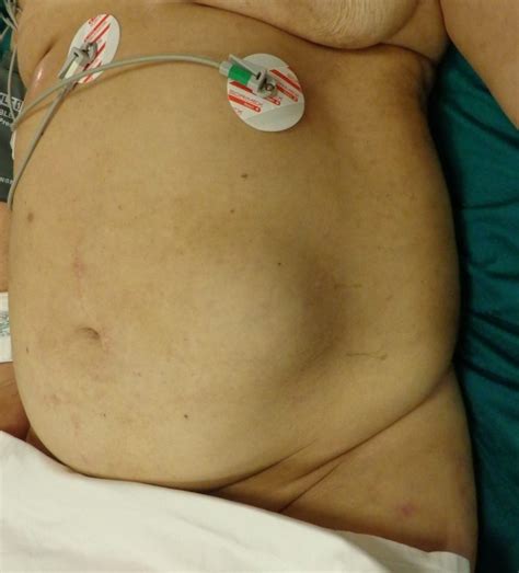 Spigelian Hernia Symptoms Get A Clarity On Symptoms And Types Of