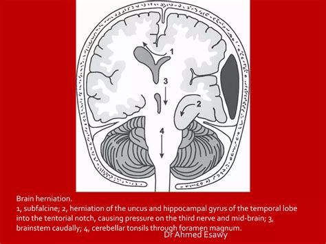 Full Story Brain Herniation Imaging Dr Ahmed Esawy Pdf