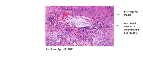 Lower Lip Bump Mucocele Versus Mucus Retention Cyst Minor Salivary