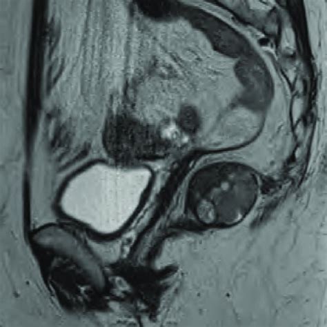 Sagittal Appearance Of Primary Mesenteric Carcinoid As Seen On Magnetic Download Scientific