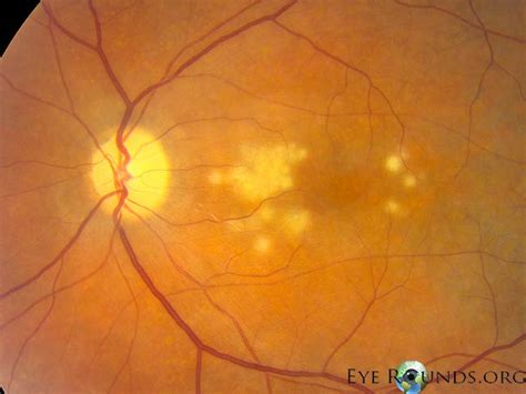Atlas Entry Diffuse Unilateral Subacute Neuroretinitis Dusn