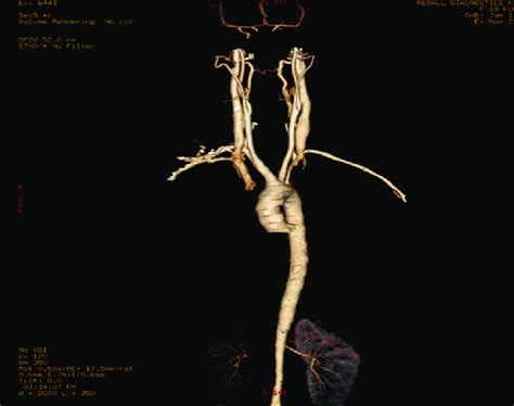 Ct Aortogram Showing Long Segment Circumferential Narrowing Of Download Scientific Diagram