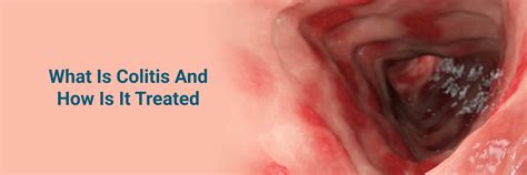 Ulcerative Colitis Uc Symptoms Causes Diagnosis Treatment