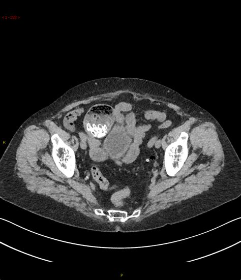 Delayed Diagnosis Of Enterolithiasis In Crohns Disease Eurorad