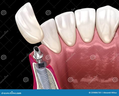 Standard Abutment Dental Implant And Ceramic Crown Medically Accurate