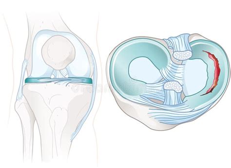 Meniscus Tears Stock Illustrations 24 Meniscus Tears Stock