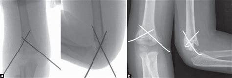 Supracondylar Fracture Pediatric Pediatrics Orthobullets