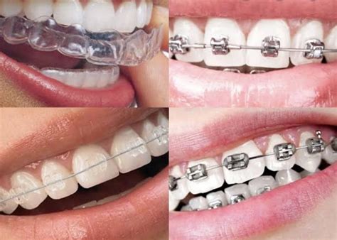 Teeth Restoration Extraction Jacket Crown Scaling Cleaning Brackets Braces Root Canal