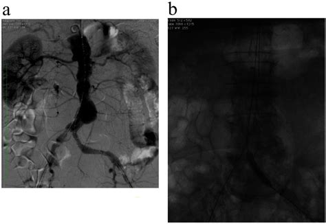 Infrarenal Abdominal Aortic Pseudoaneurysm Is It A Real Emergency Pmc