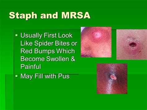 Bug Bite Vs Staph Infection