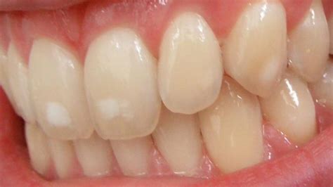 How To Prevent Decalcification Of Teeth Teethandtooth