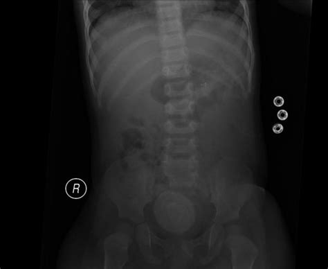 Bladder Calculus Pacs